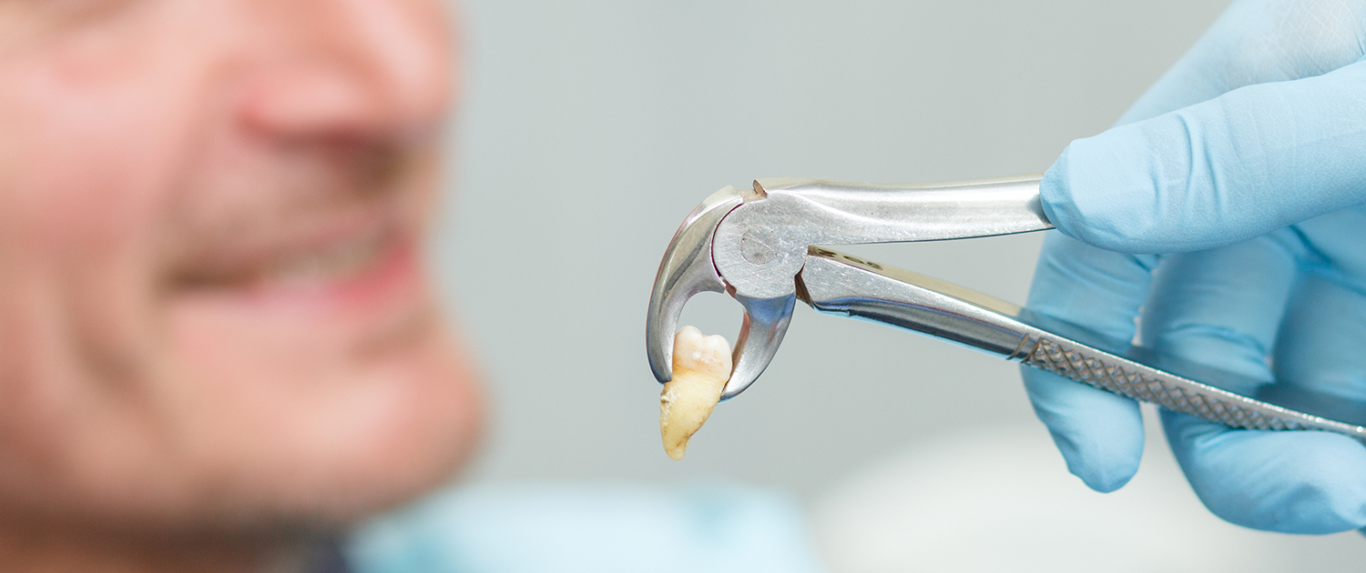 Xειρουργική Στόματος - Εξαγωγή Δοντιού - Periodental Care